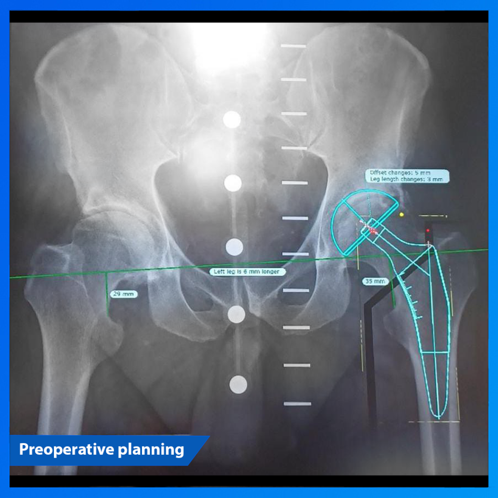 PTC UTS surgeries by anterior approach, using U-Motion II™ Cup and UTS ...